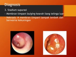 Otitis media akut | PPT