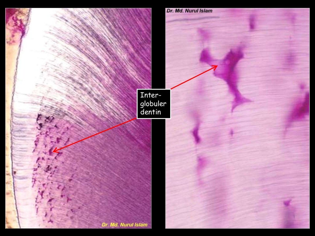 dentin pattern of mineralization, 1ry 2nd 3ry dentin formation and ro…