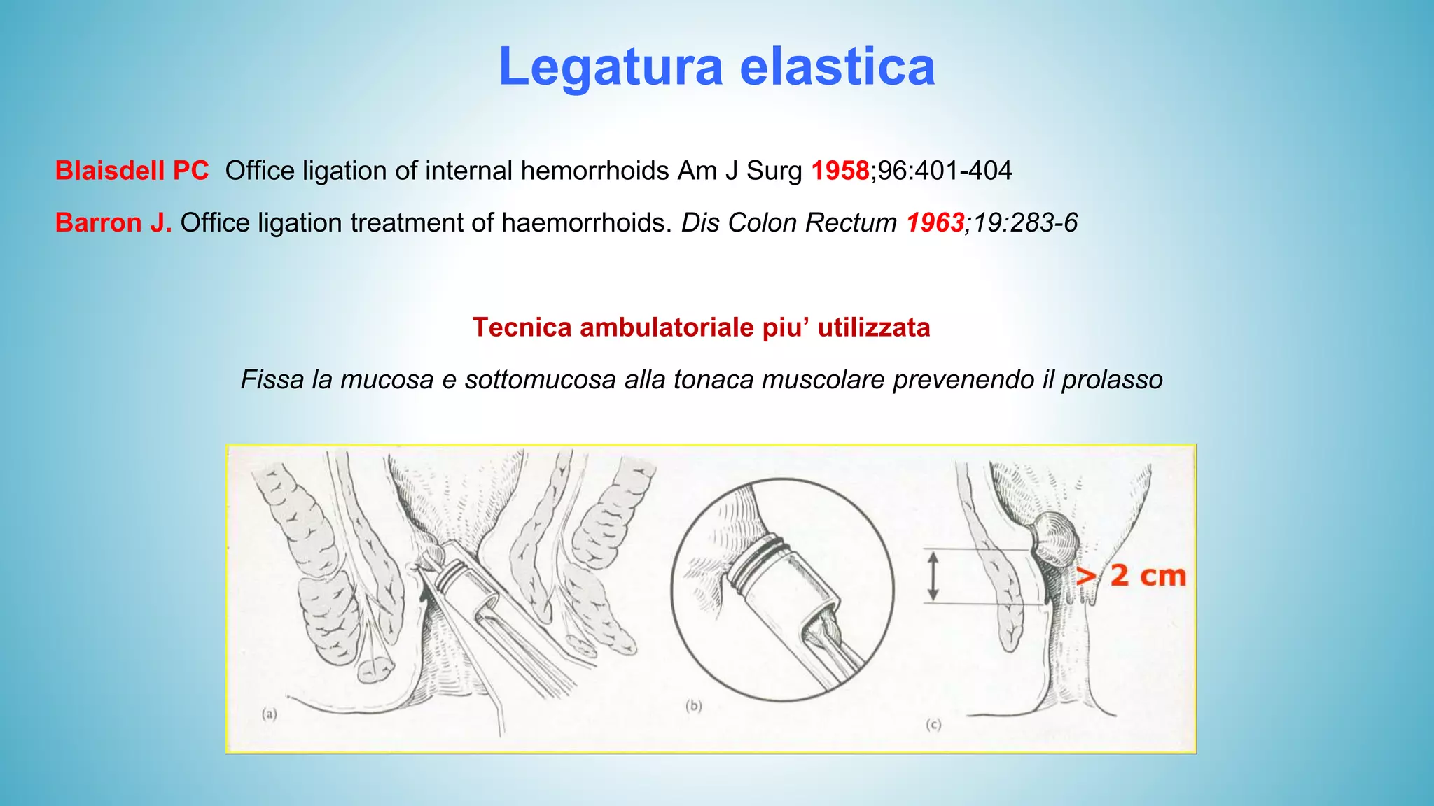 Emorroidi terapie ambulatoriali | PPTX