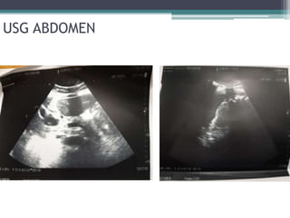 EMPHYSEMATOUS PYELONEPHRITIS | PPTX