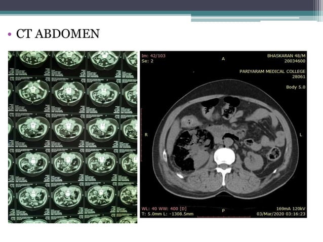 EMPHYSEMATOUS PYELONEPHRITIS | PPT
