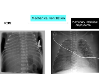 Pulmonary Interstitial Emphysema