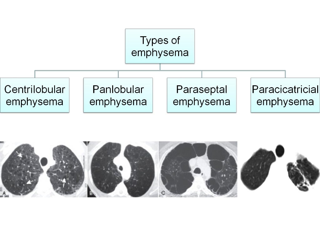 Emphysema