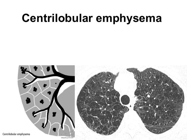 Emphysema