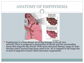 Emphysema | PPT