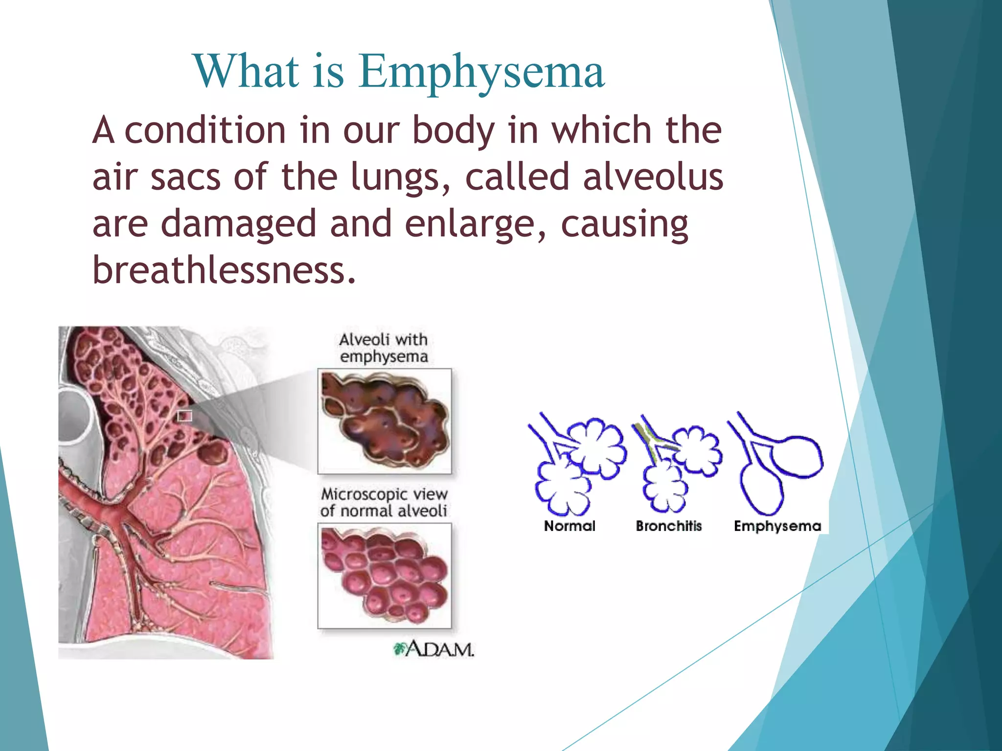 Emphysema | PPTX