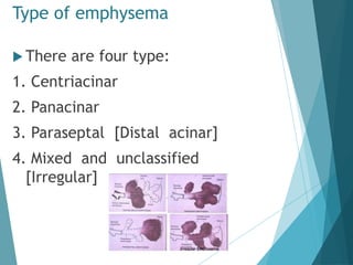 Emphysema | PPTX