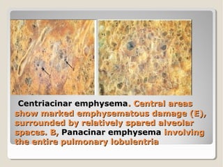 Emphysema | PPT | Lung and Respiratory Health | Diseases and Conditions