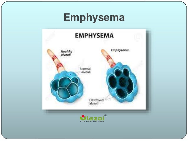 Emphysema