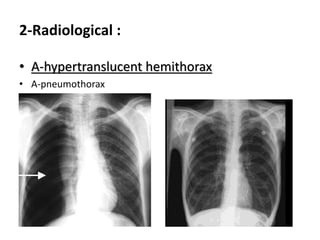 Emphysema | PPTX