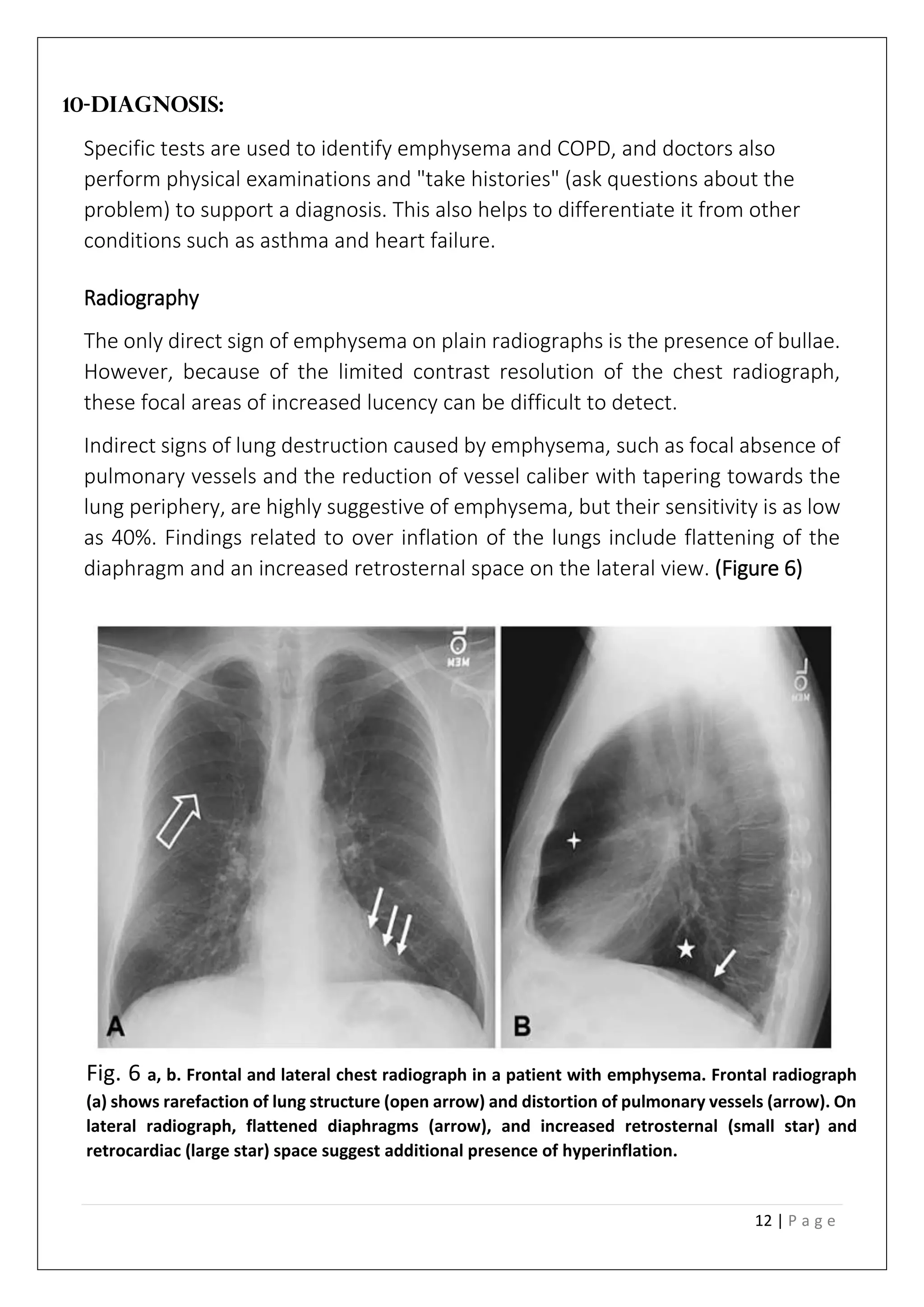 Emphysema | PDF