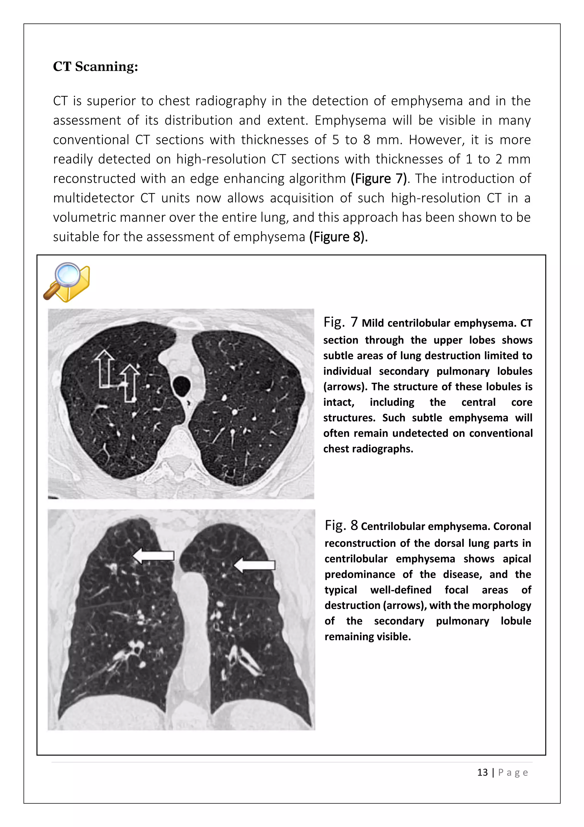 Emphysema | PDF