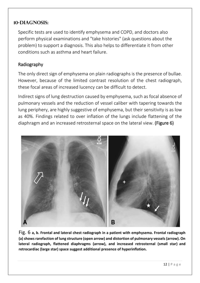 Emphysema | PDF