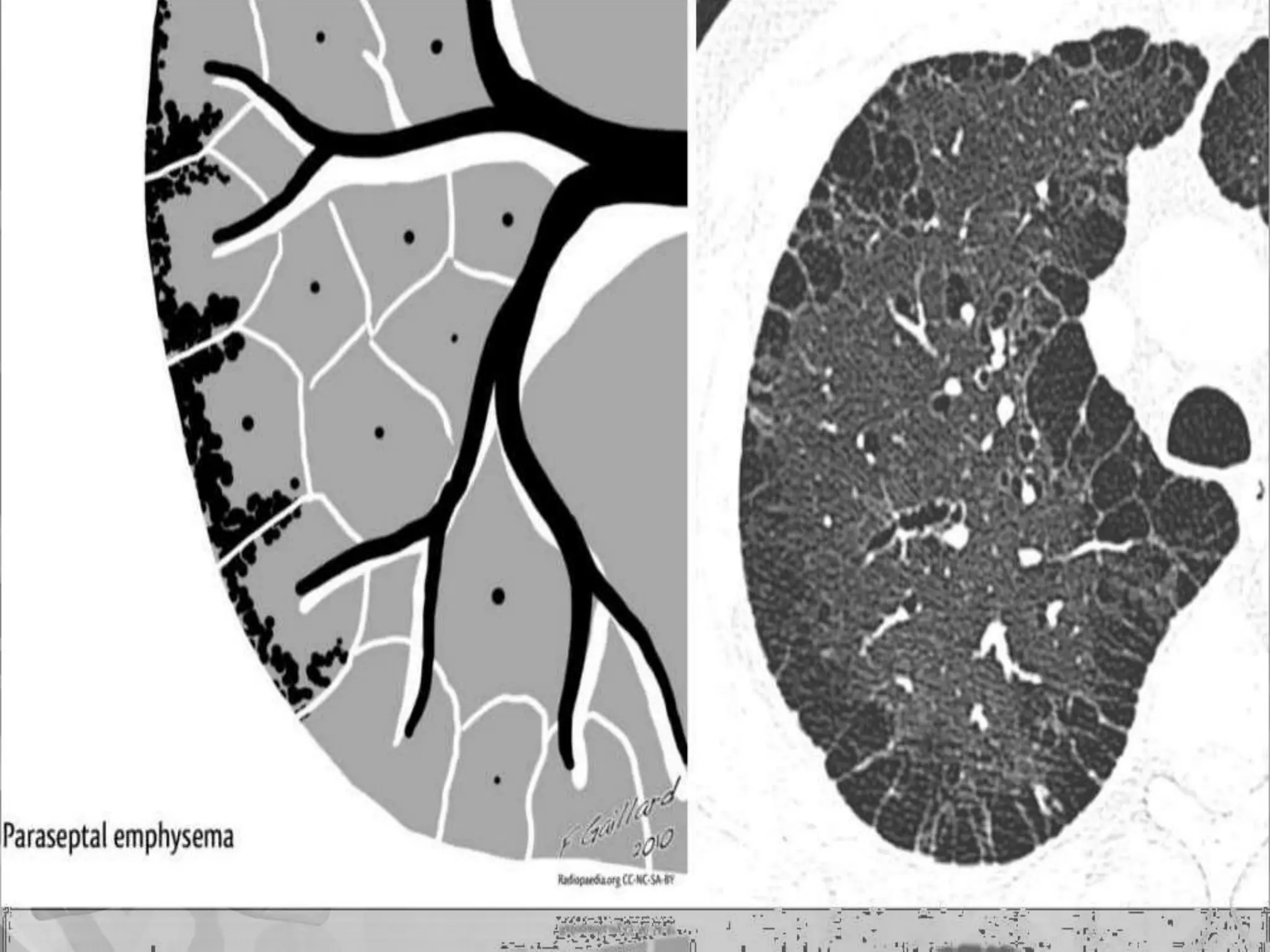 Emphysema (COPD) | PPTX