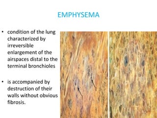 Emphysema | PPTX