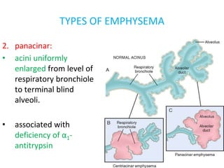 Emphysema | PPTX