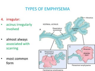 Emphysema | PPTX