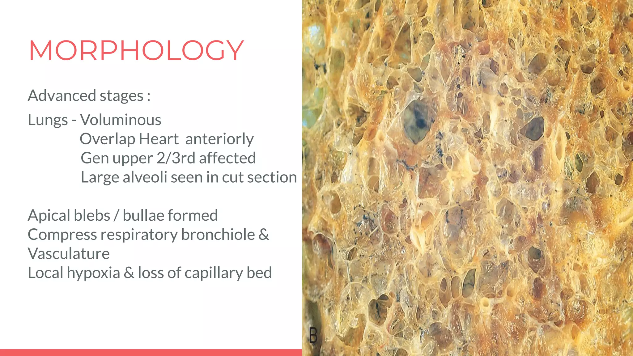 Emphysema | PDF
