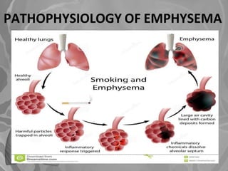 Emphysema.pptx