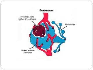 Nursing Care of Emphysema patient .pptx