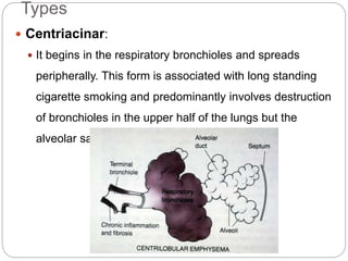Nursing Care of Emphysema patient .pptx