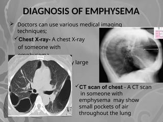 Emphysema.pptx77777777777777777777777777777 | PPT