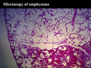 Emphysema Slide Labeled