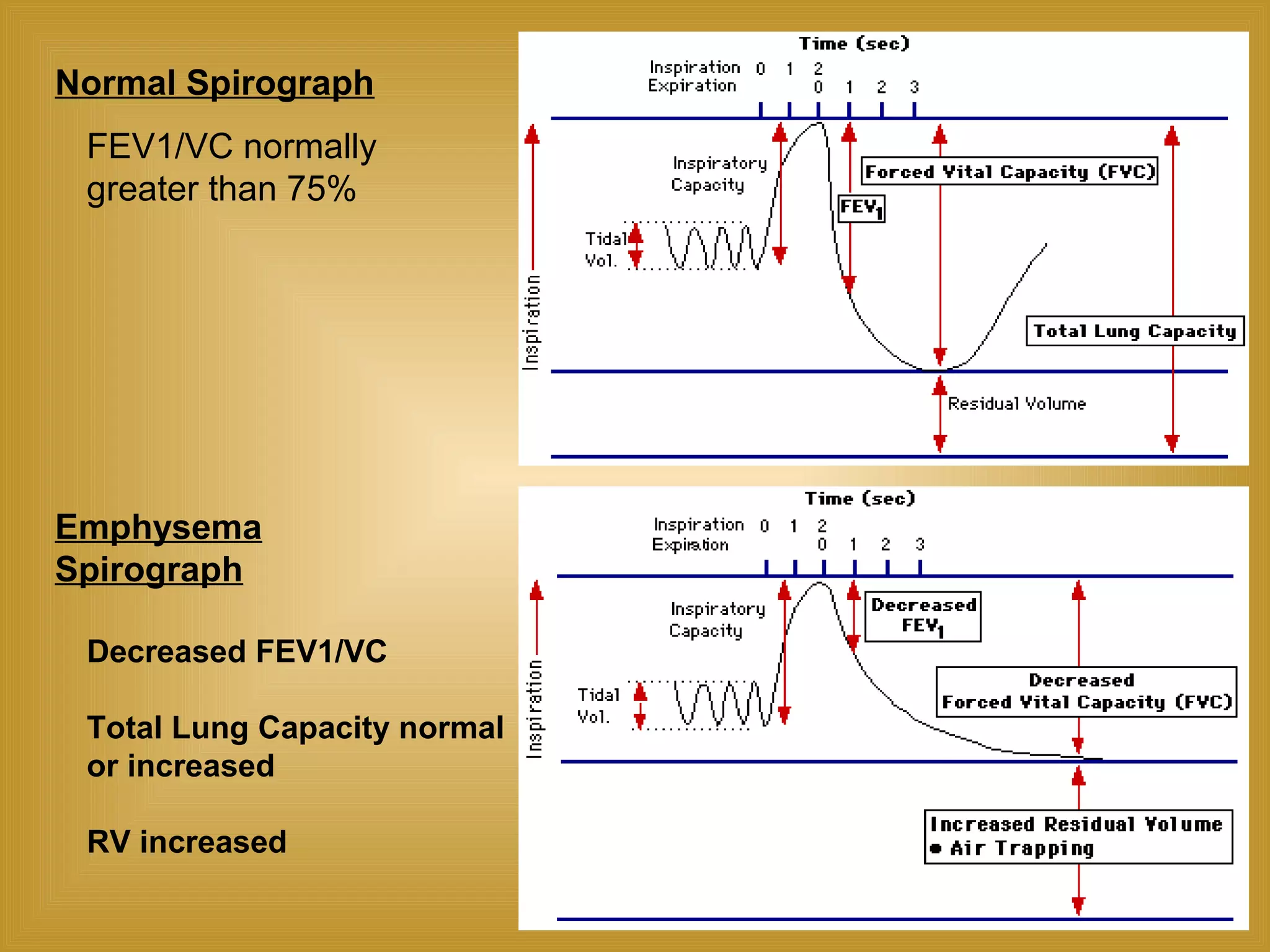 Emphysema (C.O.P.D.) | PPT