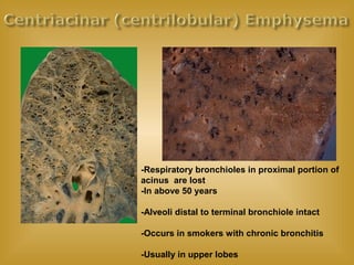 Emphysema (C.O.P.D.) | PPT