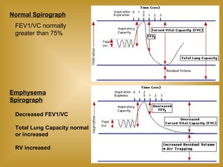 Emphysema (C.O.P.D.) | PPT