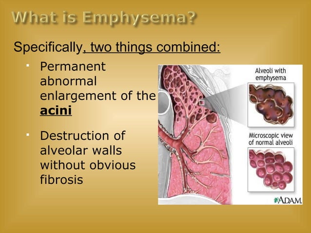 Emphysema (C.O.P.D.) | PPT | Lung and Respiratory Health | Diseases and ...