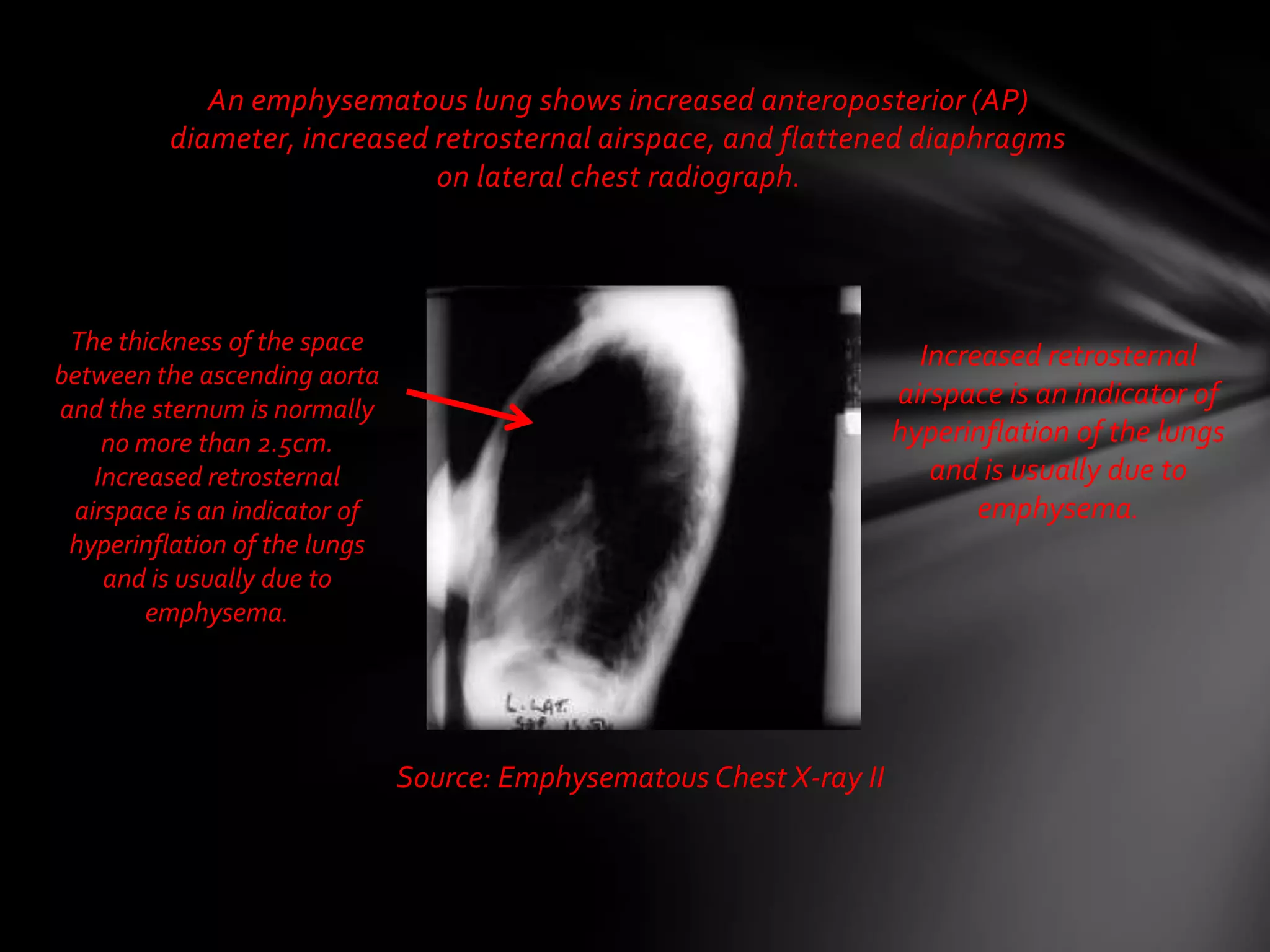 Emphysema and alfa 1 antitrypsin | PPTX