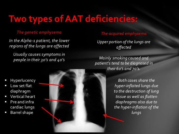 Emphysema and alfa 1 antitrypsin