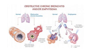 Emphysema and chronic bronchitis | PPTX