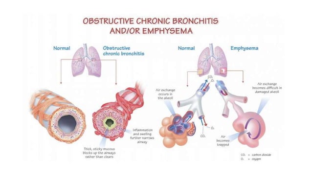 Emphysema and chronic bronchitis | PPT