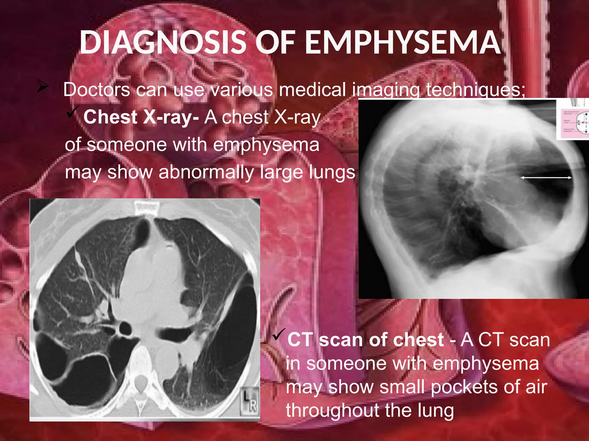 emphysema done.pptxhshshhshsshshshshhshhsss | PPTX