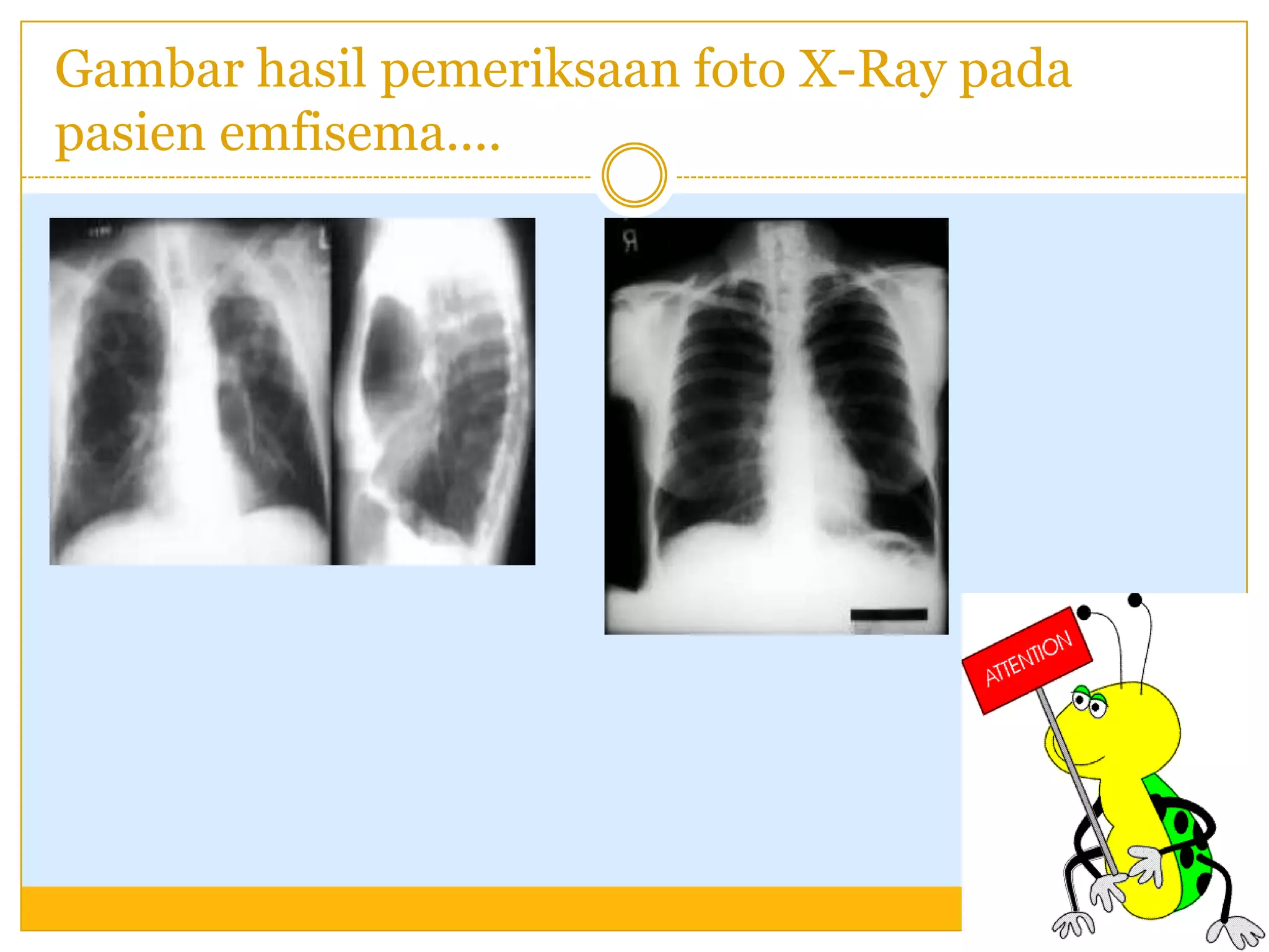 Emphysema paru | PPT