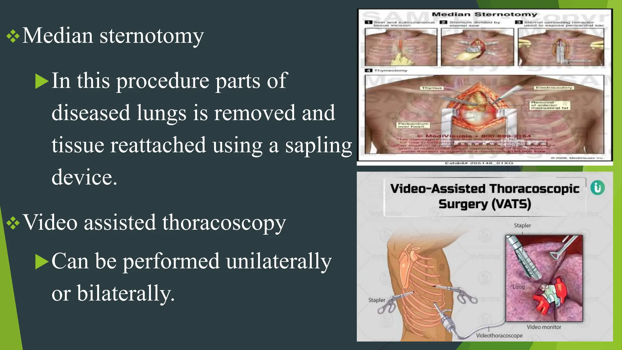NURSING MANAGEMENT OF PATIENT WITH EMPHYSEMA .PPT
