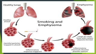 NURSING MANAGEMENT OF PATIENT WITH EMPHYSEMA .PPT