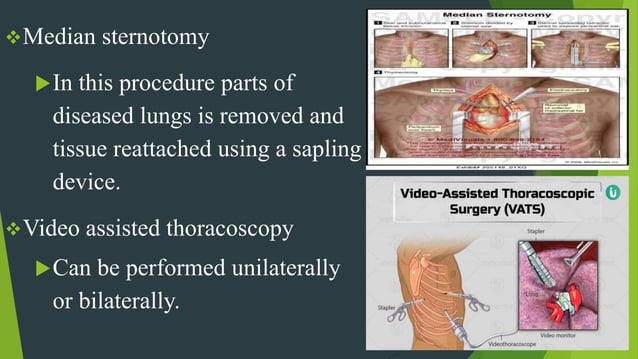 NURSING MANAGEMENT OF PATIENT WITH EMPHYSEMA .PPT | Lung and ...