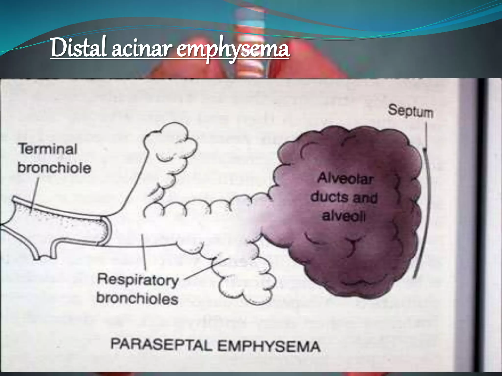 Emphysema ppt | PPTX