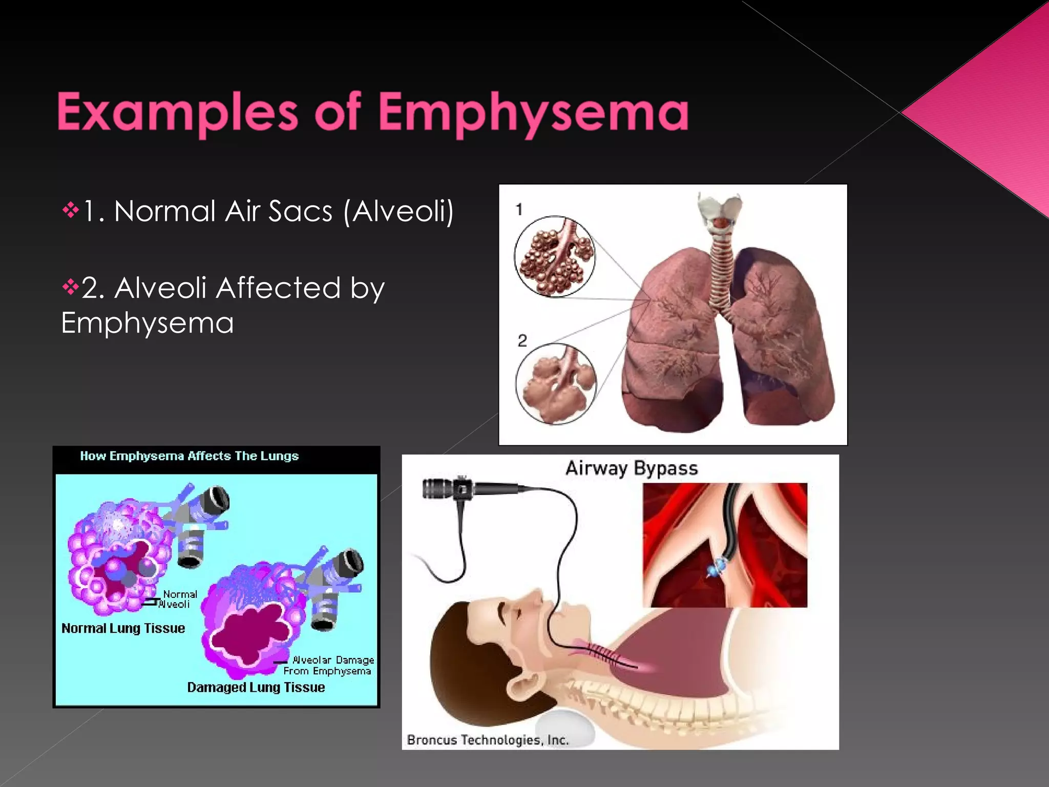 Student Work Emphysema | PPT | Illegal Drugs, Tobacco, eCigarettes ...