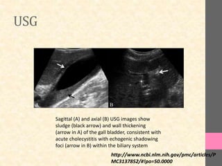 Emphysematous cholecystitis | PPTX