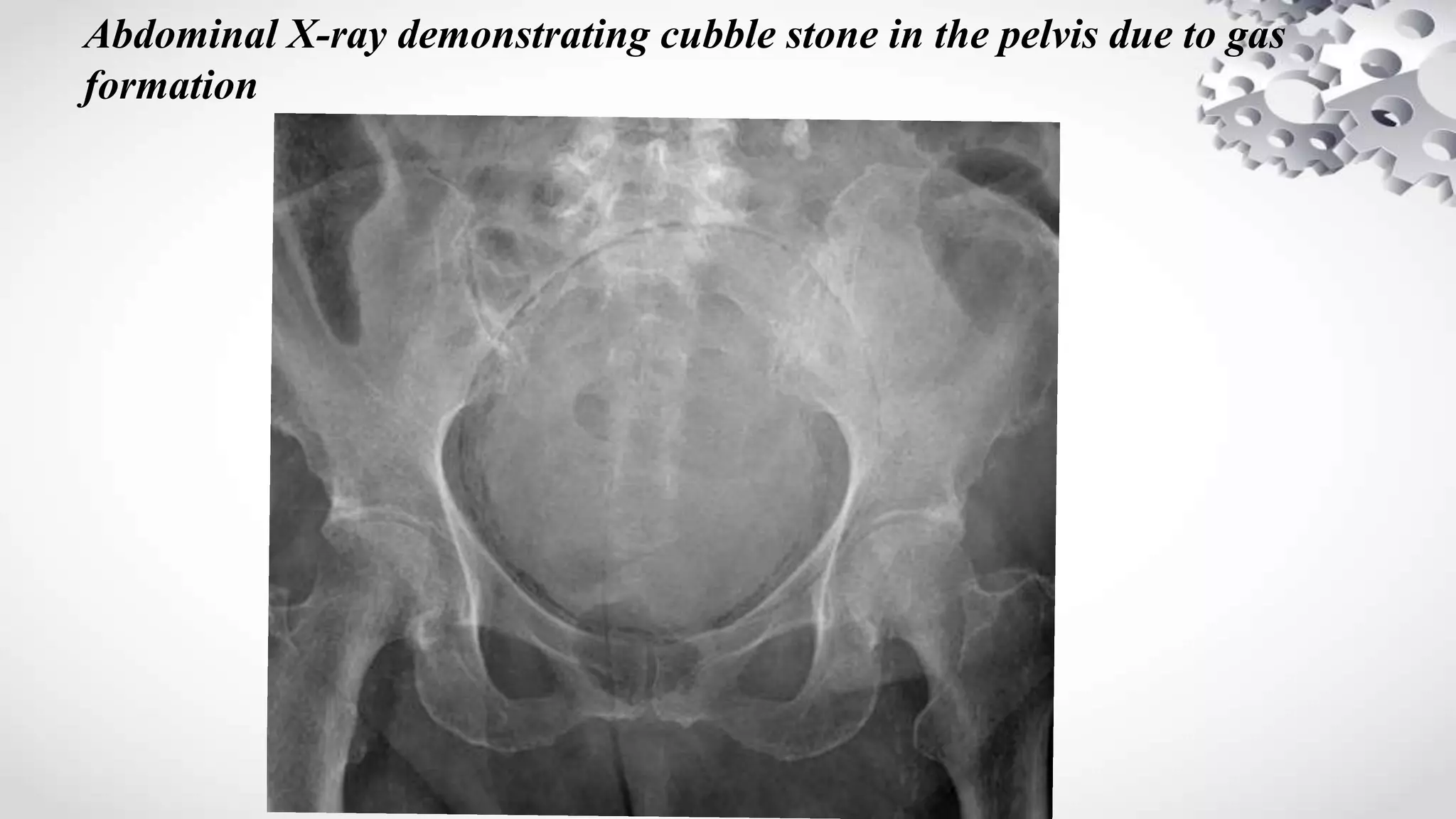 Emphysematous cystitis on ultrasound x ray and ct | PPTX