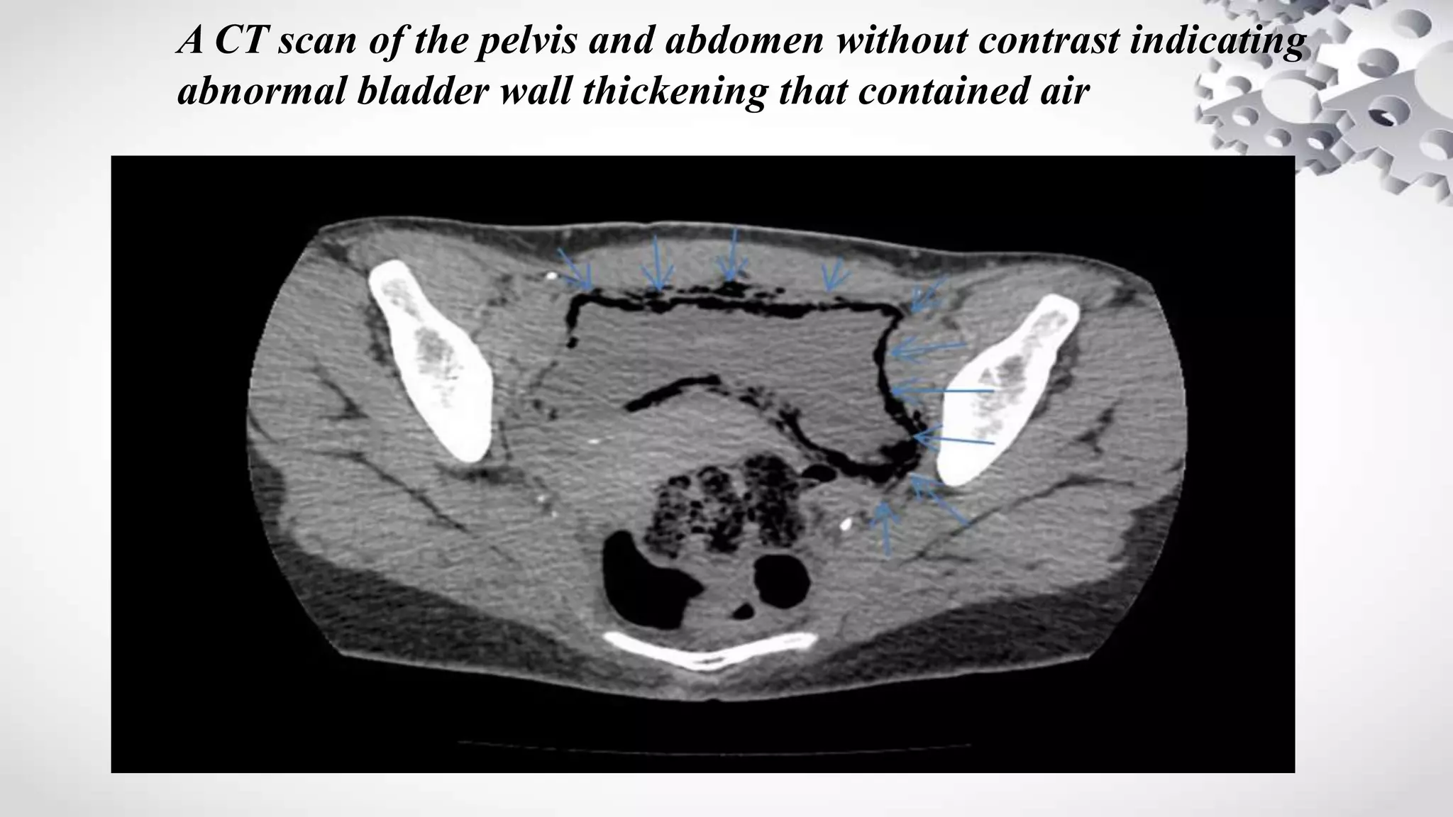 Emphysematous cystitis on ultrasound x ray and ct | PPTX