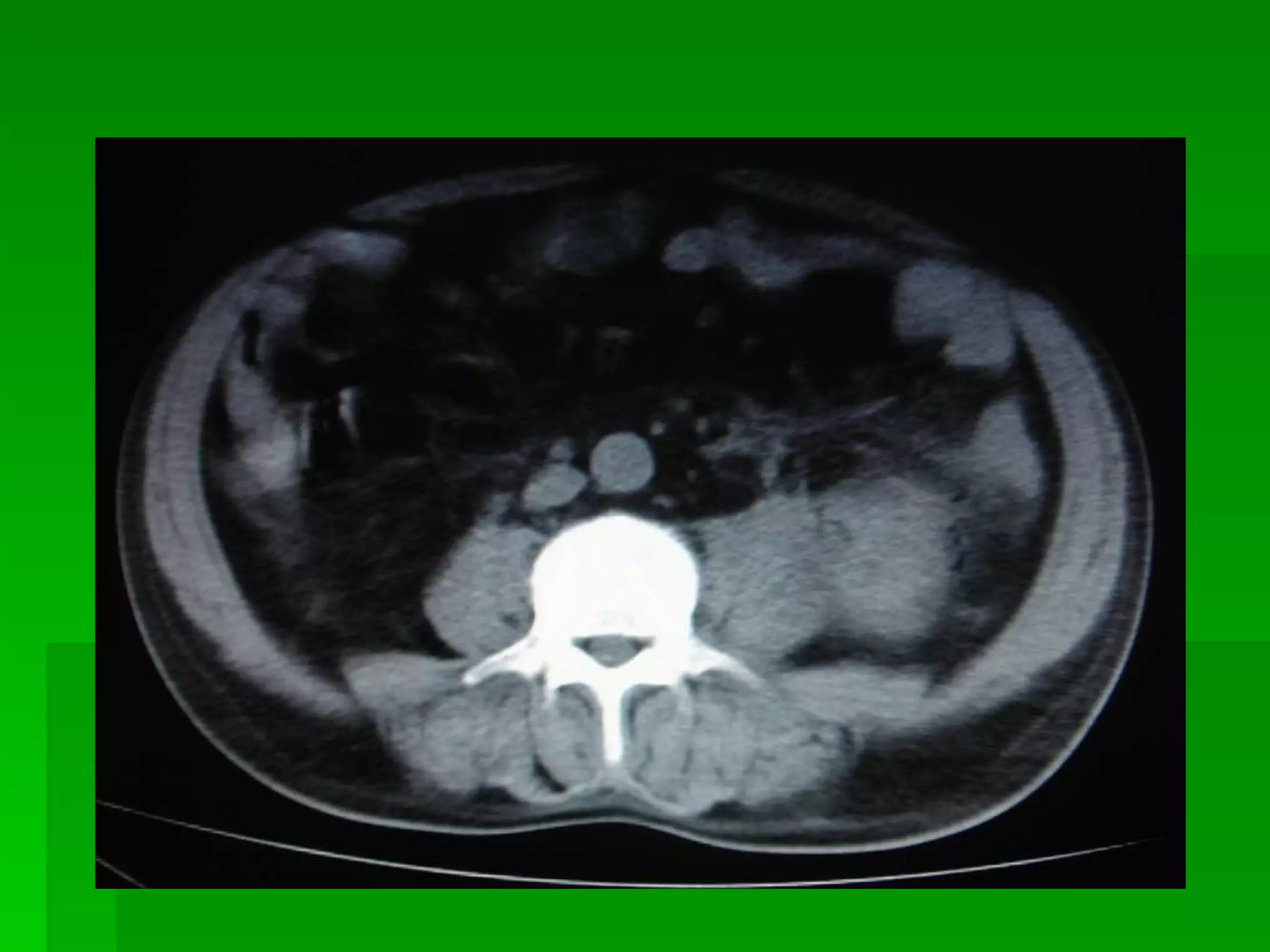 CT: Emphysematous Pyelonephritis | PPT