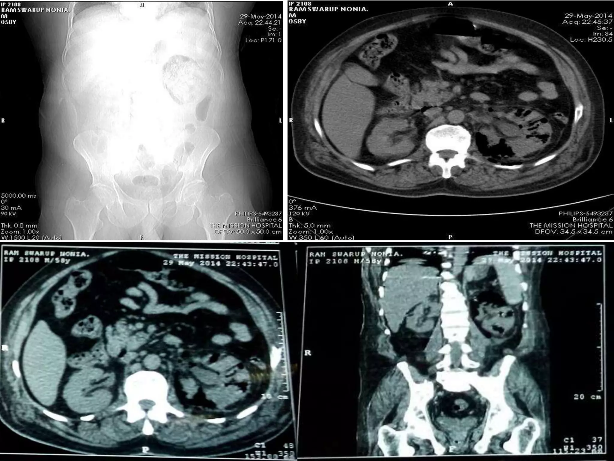 Emphysematous pyelonephritis- case discussion | PPTX