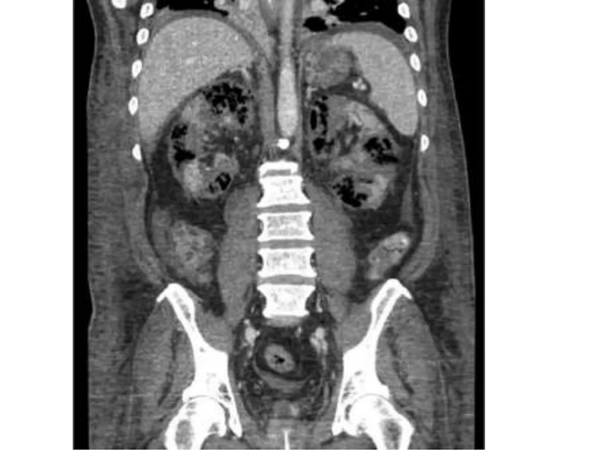 Emphysematous pyelonephritis | PPTX