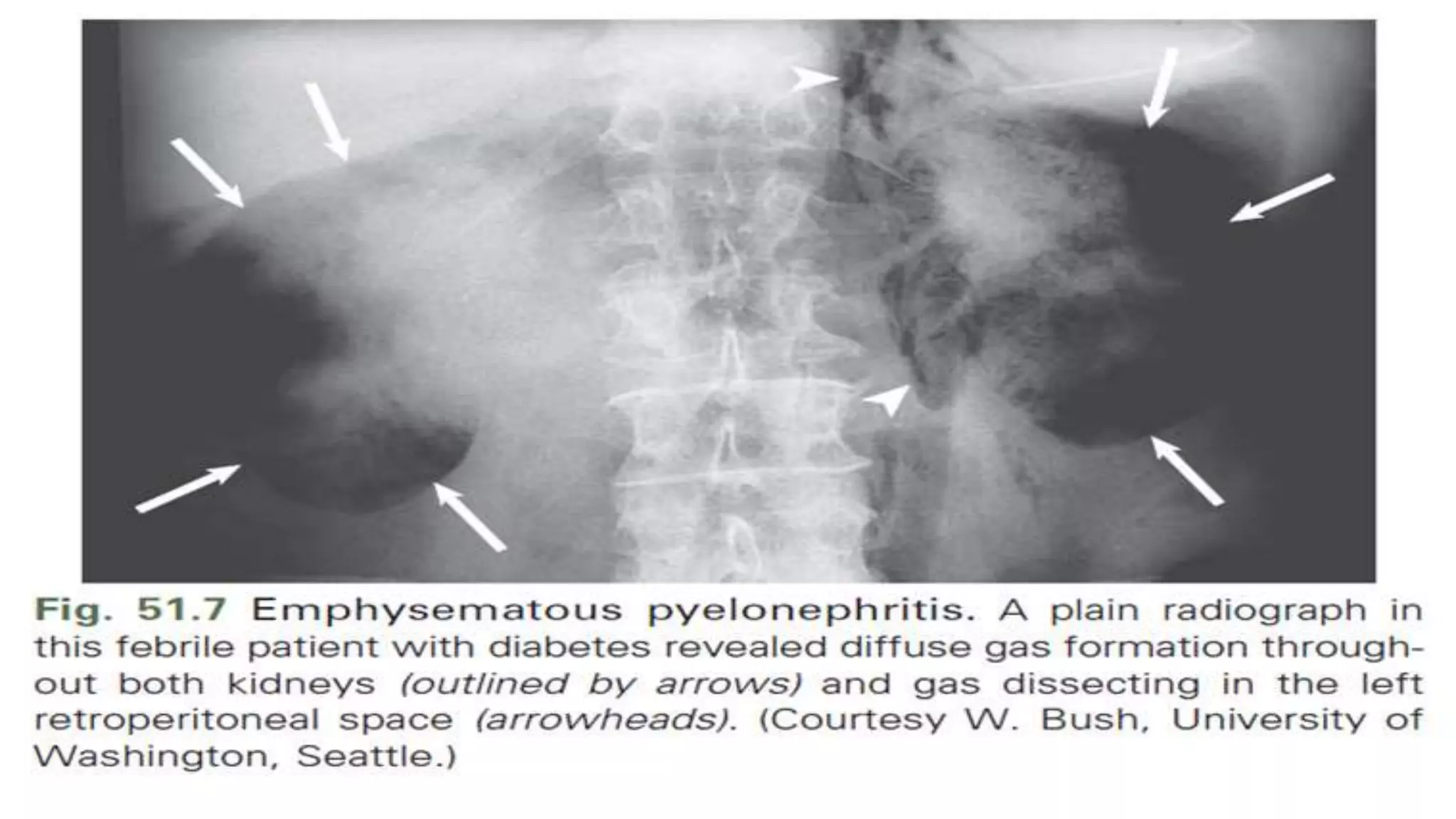 Emphysematous Pyelonephritis.pptx