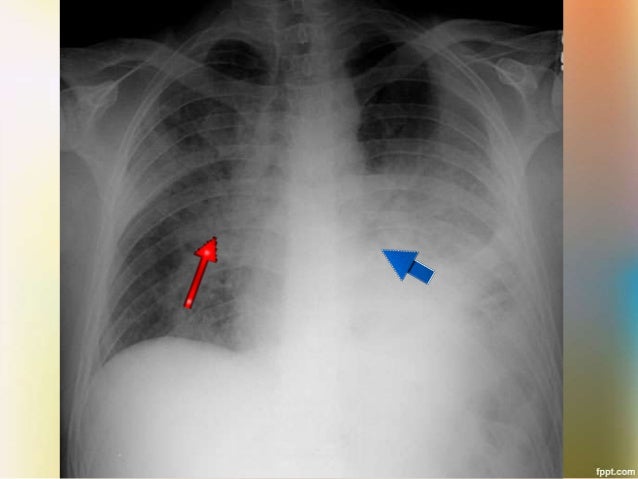 EMPIEMA PULMONAR